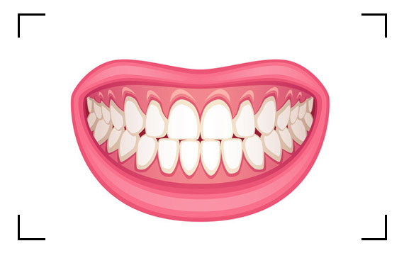 FOREVER Aligners - Carter Orthodontics