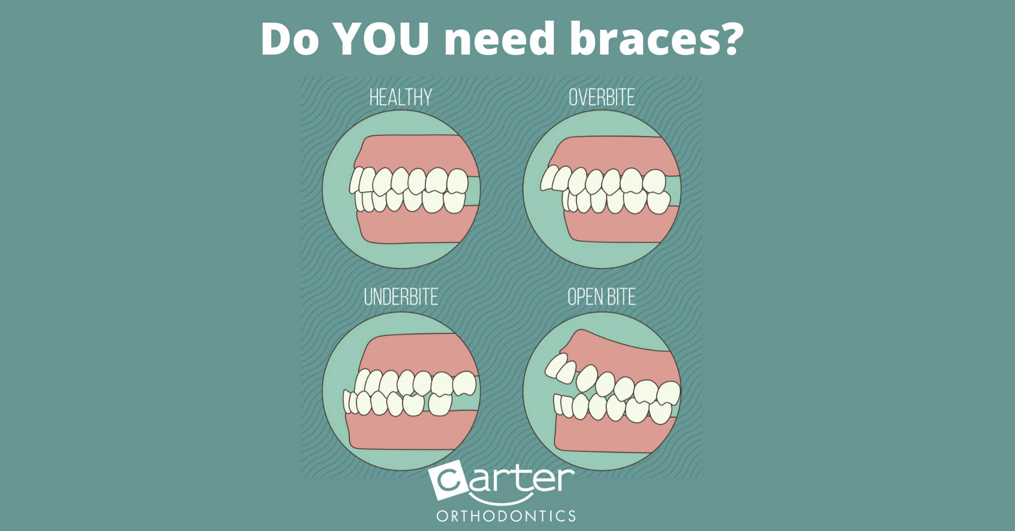 Do you need braces or aligners? - Carter Orthodontics Do you need braces or aligners? - Carter Orthodontics